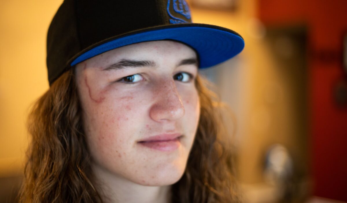 Syracuse teen Cole Cheney continues recovery from horrific dirt bike ...